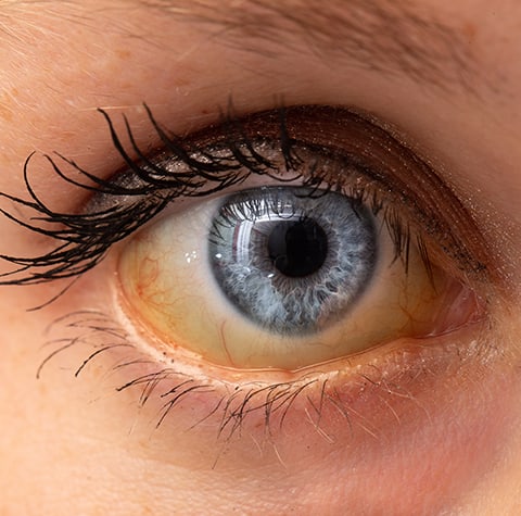 Dry Eye | Shelburne Optometry | Ontario